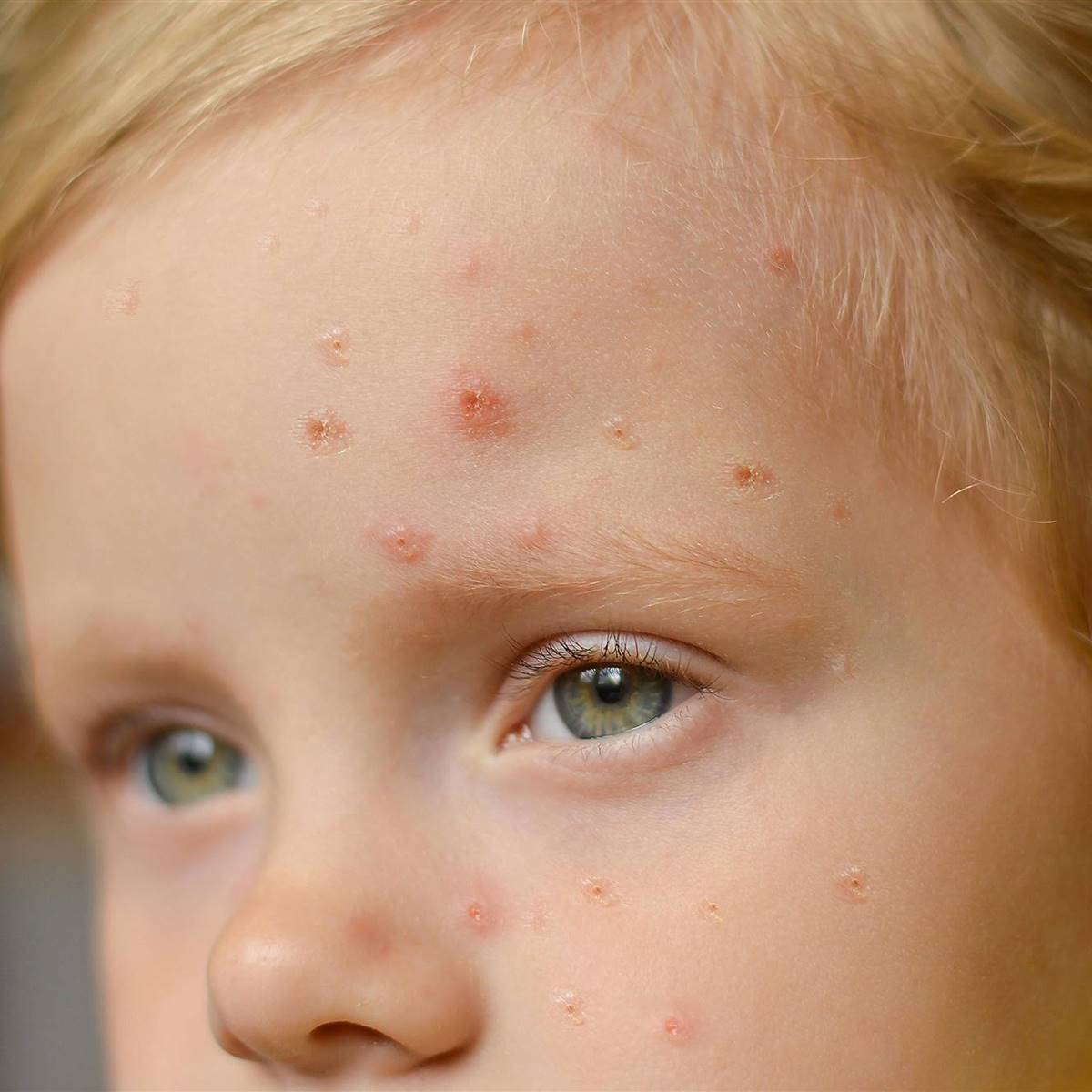 Viruela símica – LA CARTA DEL DOCTOR